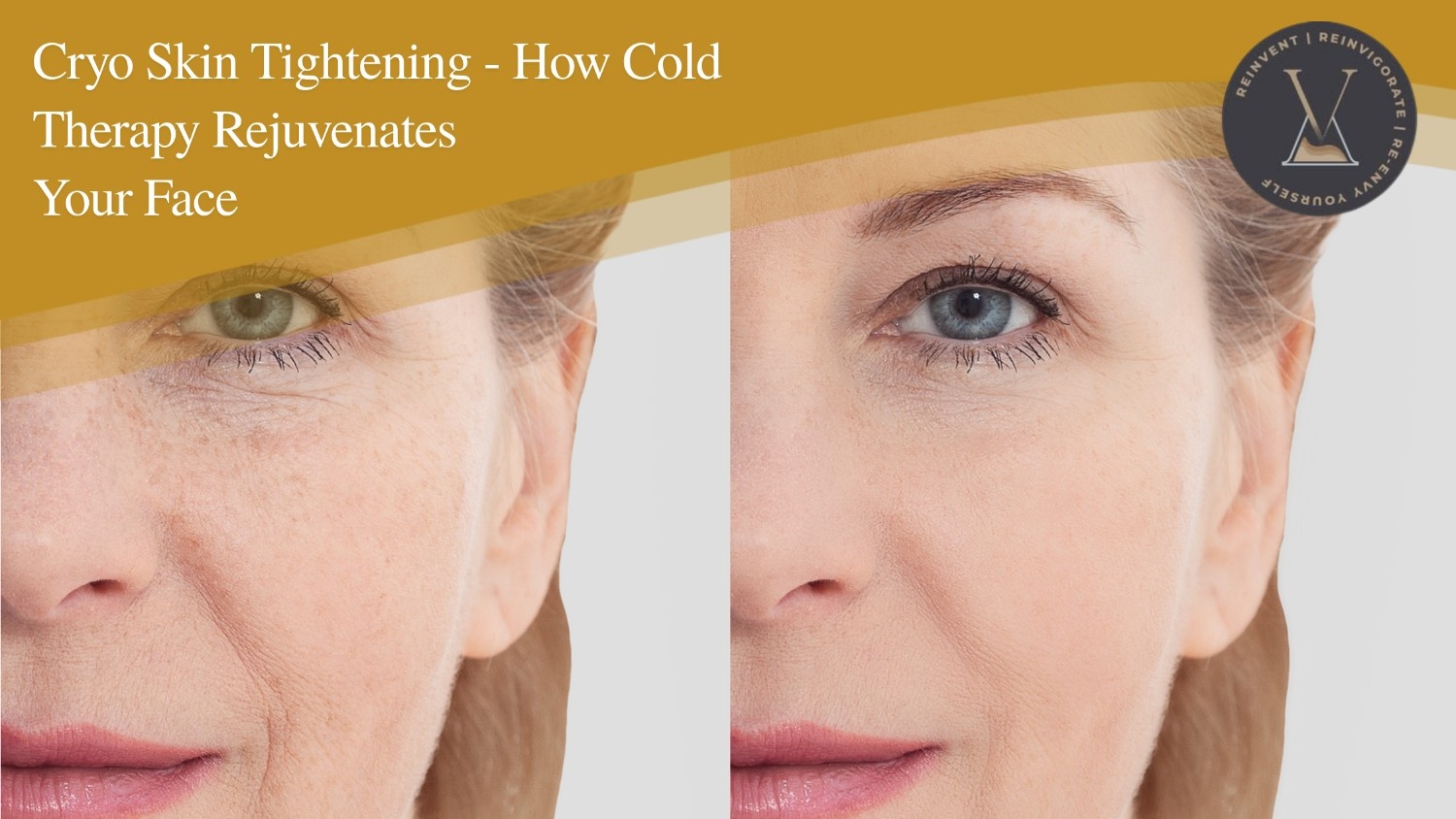 Cryo Skin Tightening How Cold Therapy Rejuvenates Your Face